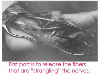 Peripheral Nerve Compression Syndrome | PPTX