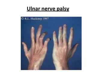 peripheralnervedisorders-131223005441-phpapp01.pptx