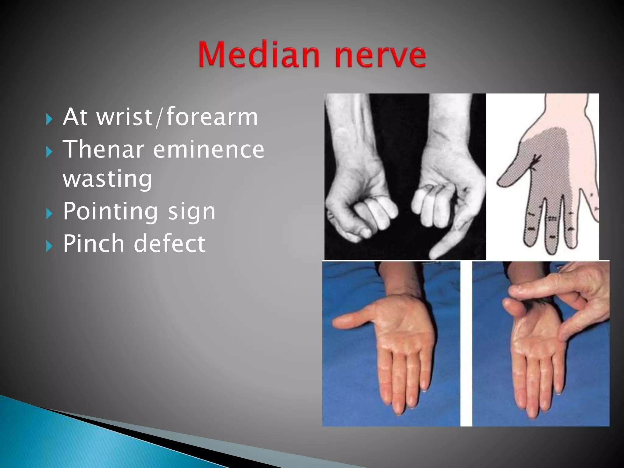 Peripheral nerve injuries | PPTX