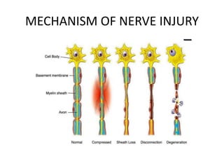 peripheral nerve injuries CLASSSIFICATION.pptx