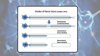 peripheral nerve injuries- classification and manifestations | PPTX