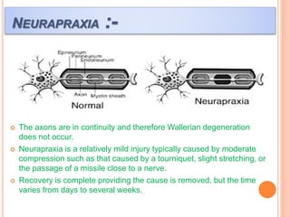 Peripheral nerve injury | PPTX