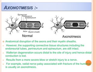 Peripheral nerve injury | PPTX