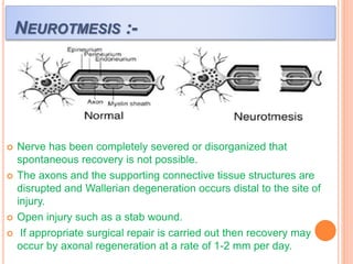 Peripheral nerve injury | PPTX