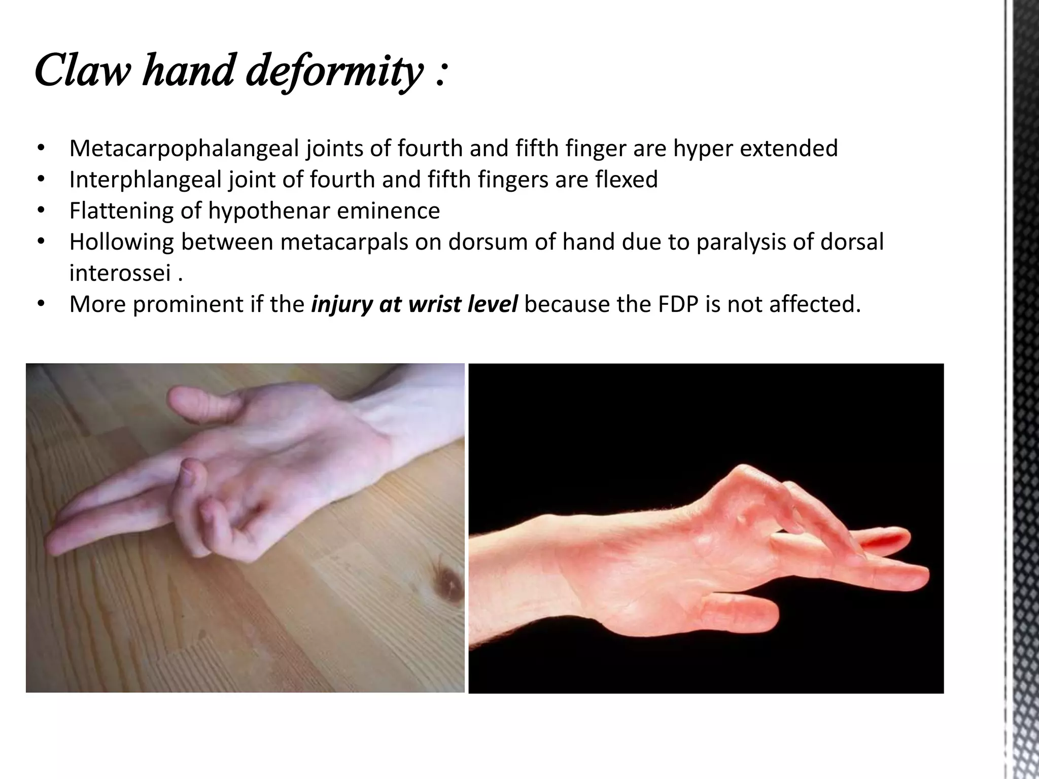 Peripheral Nerve Injury | PPTX