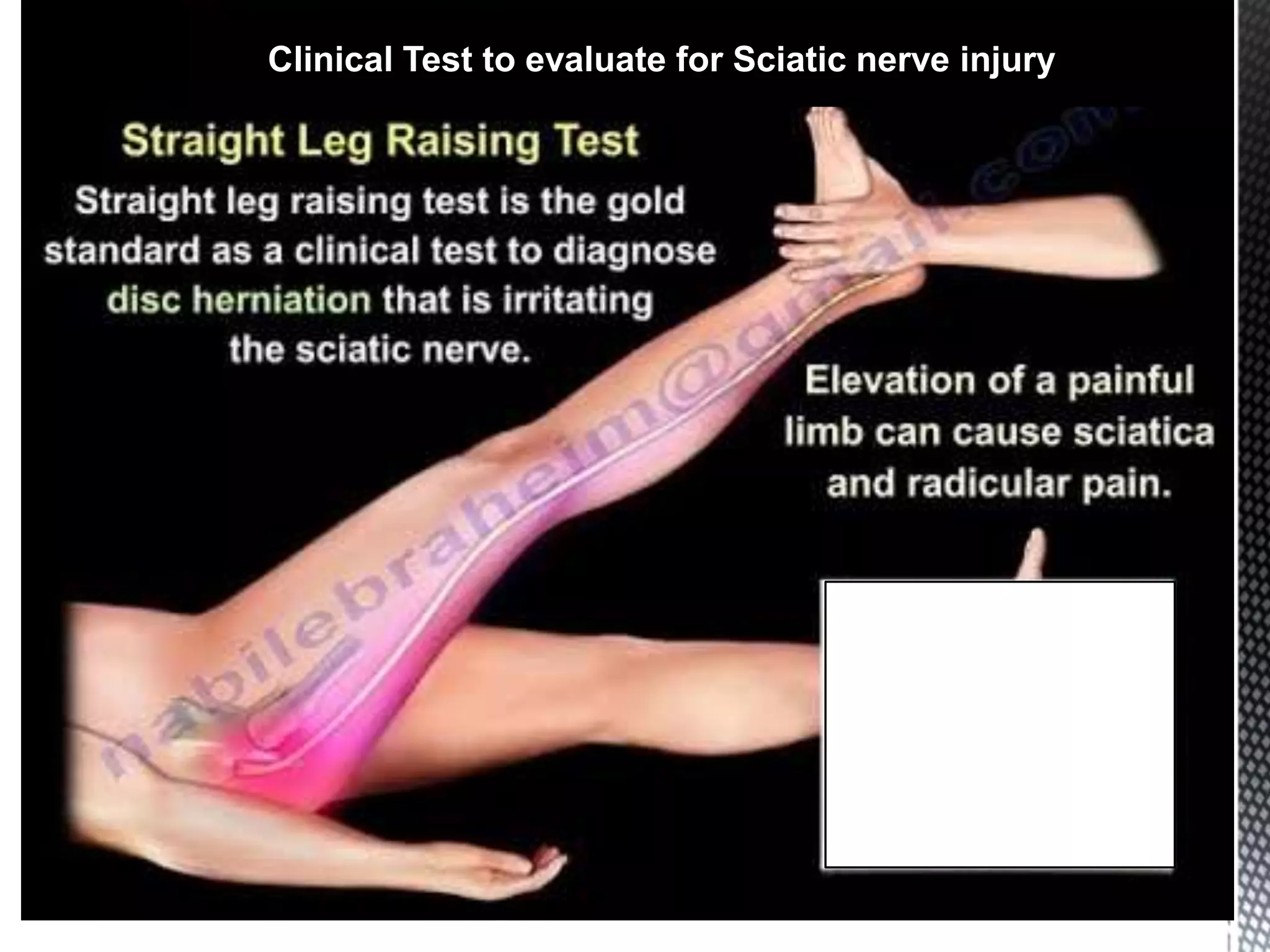 Peripheral Nerve Injury | PPTX
