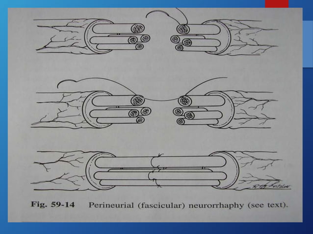 Peripheral nerve injury by dr ashutosh | PPT