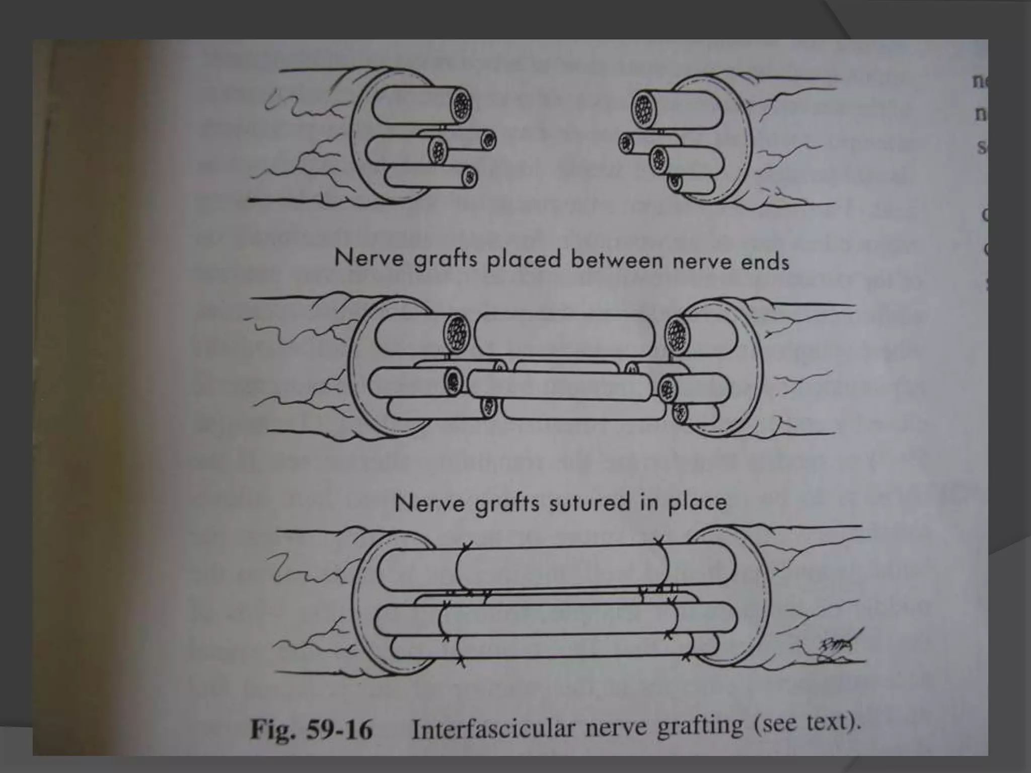 Peripheral Nerve Injury (Part-II) | PPTX