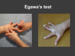 Egawa Test #ulnar #dorsal #interossei Median Nerve, Ulnar, 44% OFF