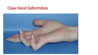 Peripheral nerve injuries of upper limb | PPTX