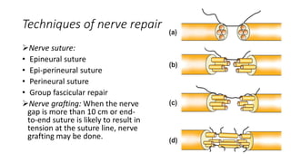 Peripheral nerve injuries of upper limb | PPTX
