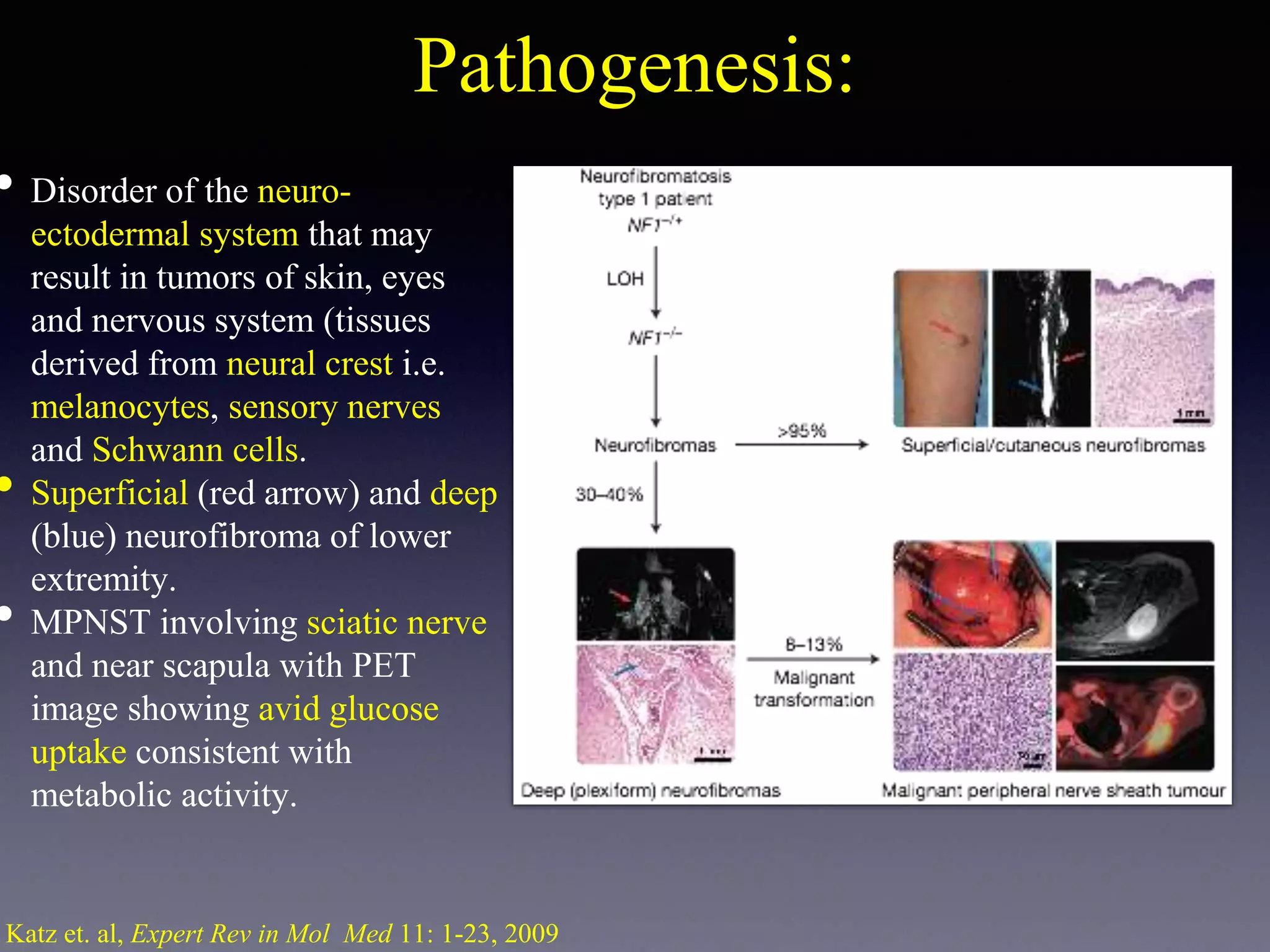 Peripheral Nerve Sheath Tumors | PPTX