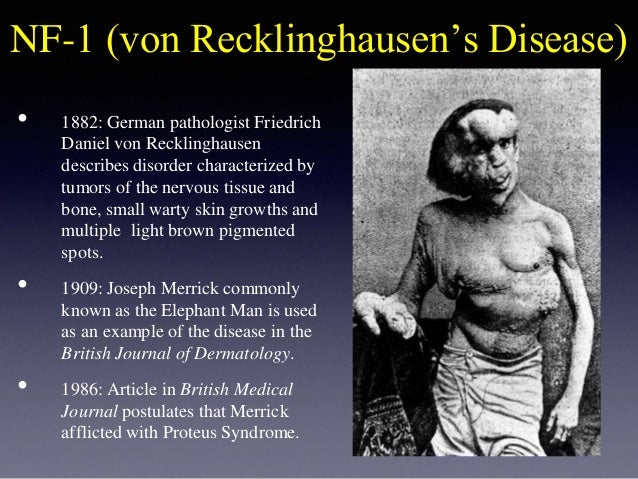 Peripheral Nerve Sheath Tumors