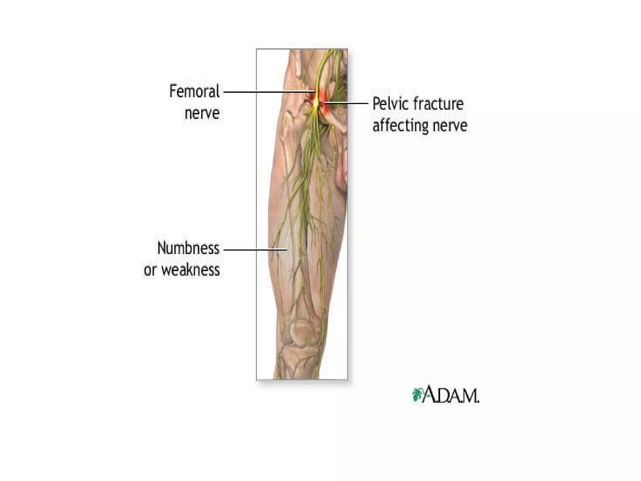 Peripheral Neuropathy - Types | PPT | Death, Injury, or Military ...