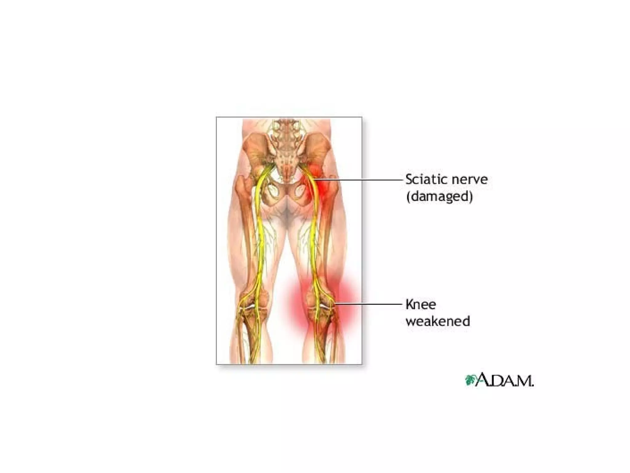 Peripheral Neuropathy - Types | PPT | Death, Injury, or Military ...