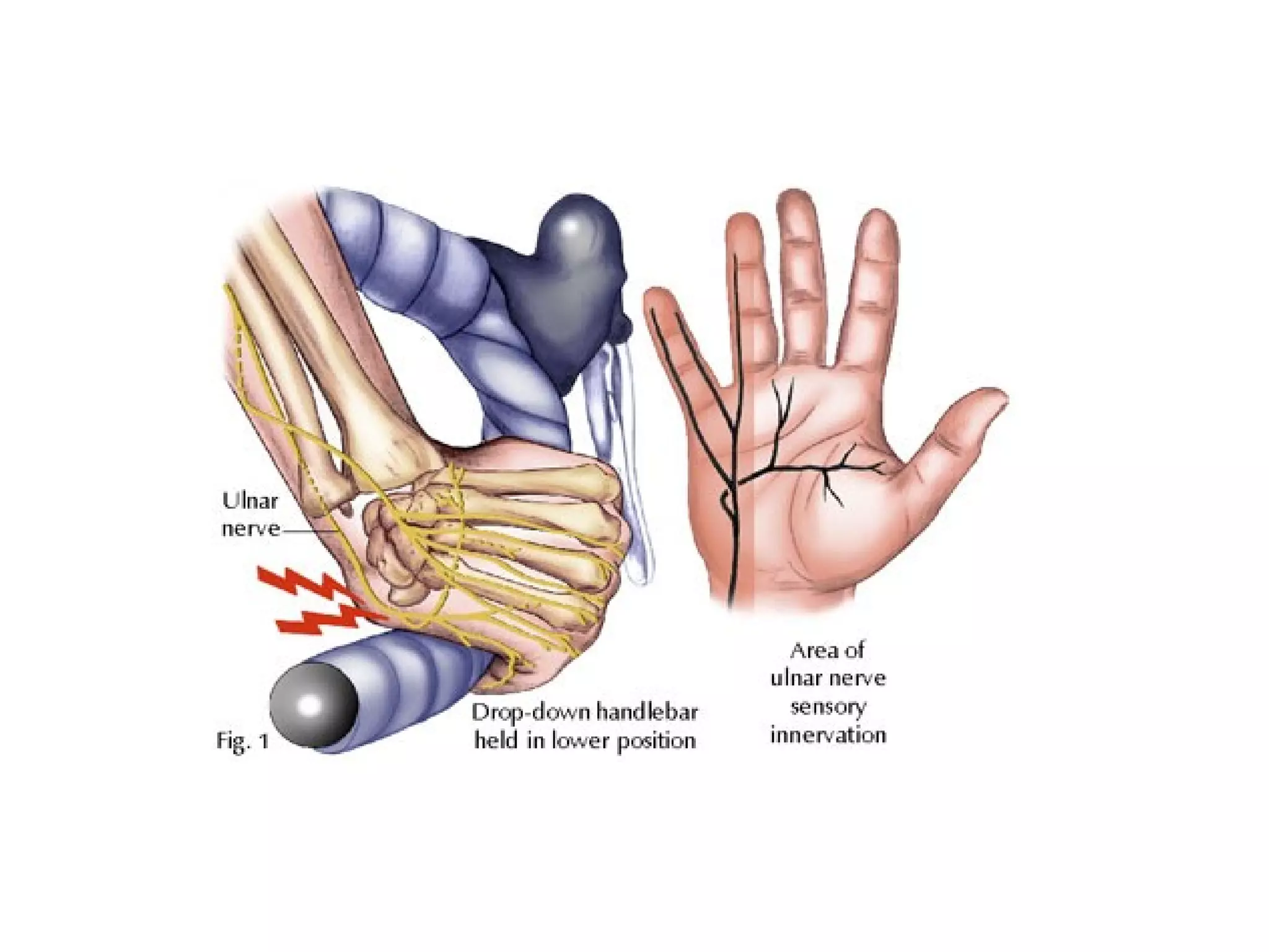Peripheral Neuropathy - Types | PPT | Death, Injury, or Military ...