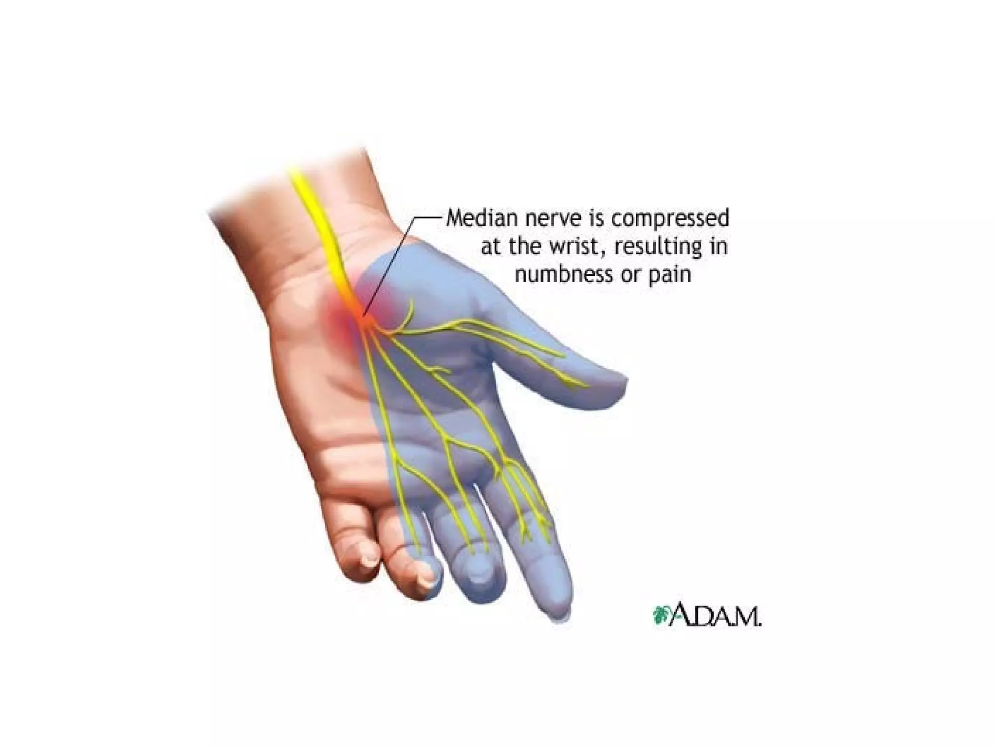 Peripheral Neuropathy - Types | PPT | Death, Injury, or Military ...