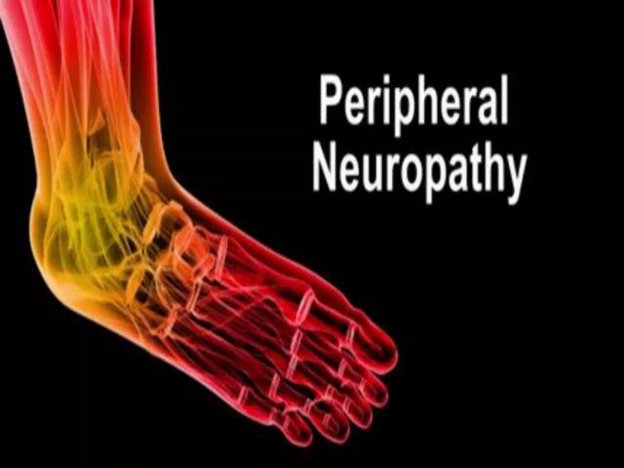 Peripheral Neuropathy | PPT