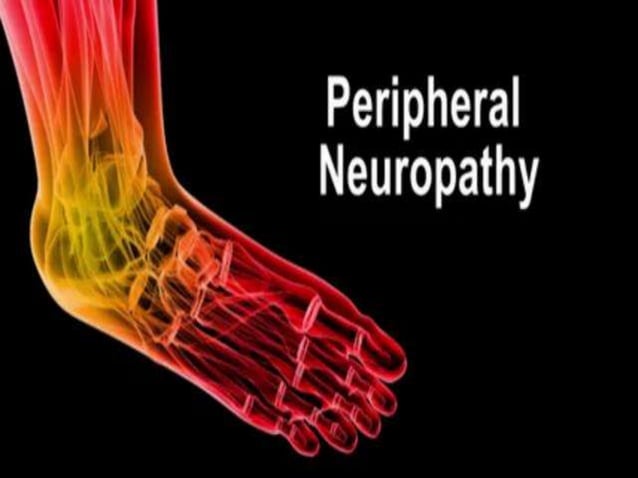 Peripheral Neuropathy | PPT