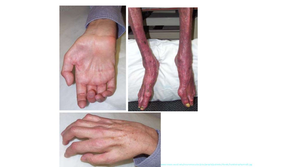 Peripheral neuropathy