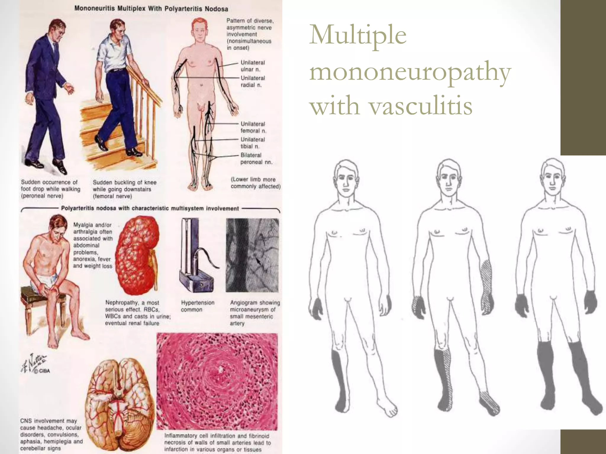 Approach to Peripheral neuropathy | PPTX