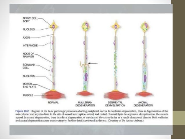 Approach to Peripheral neuropathy