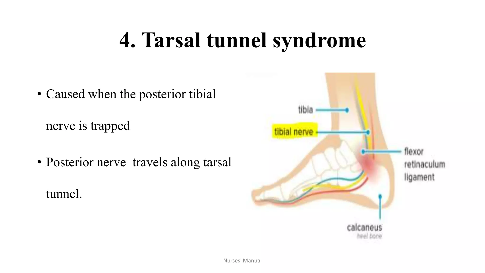 Peripheral Neuropathy | PPTX