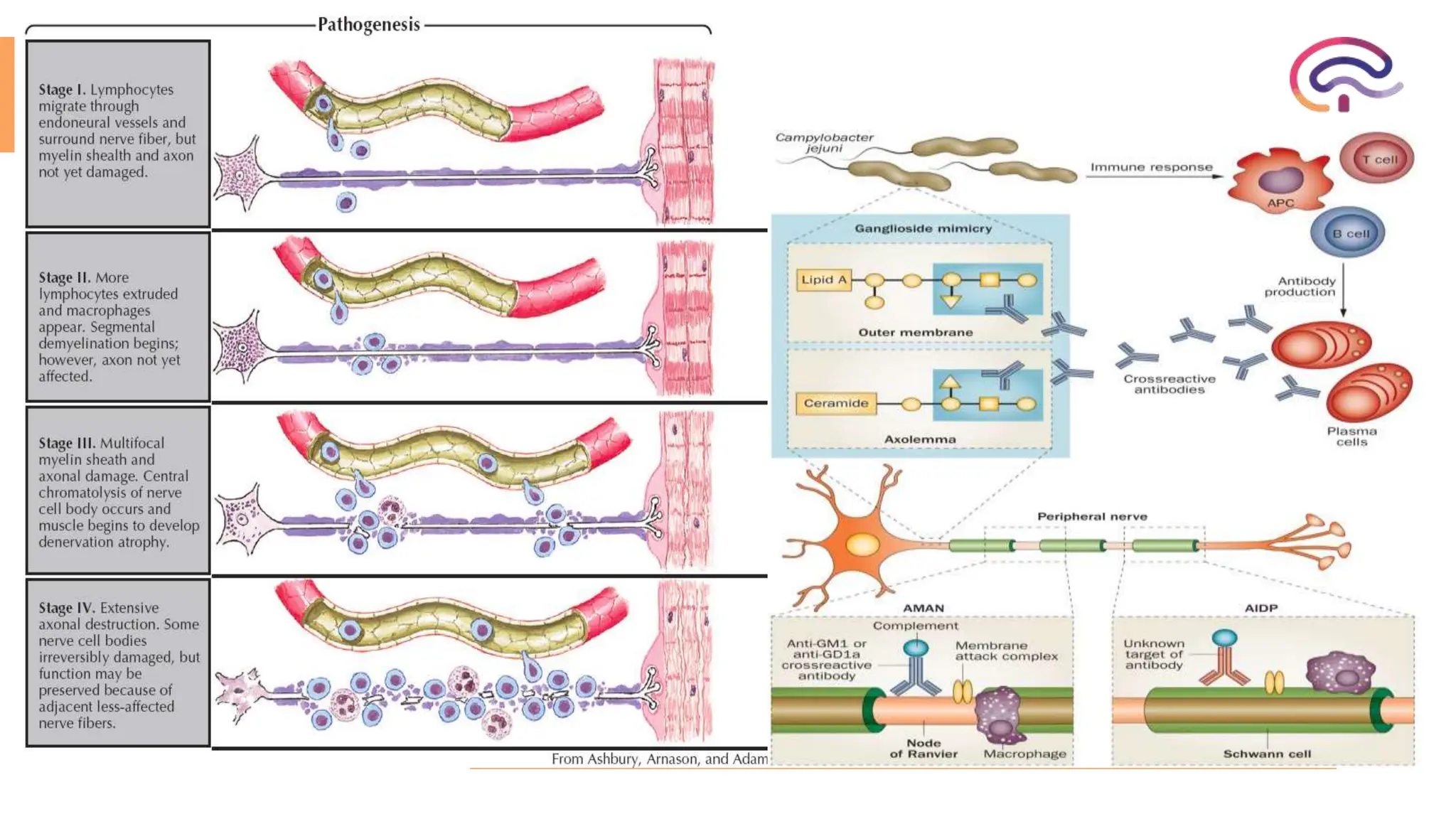 peripheral neuropathy (introduction and Gillian barre syndrome .pptx