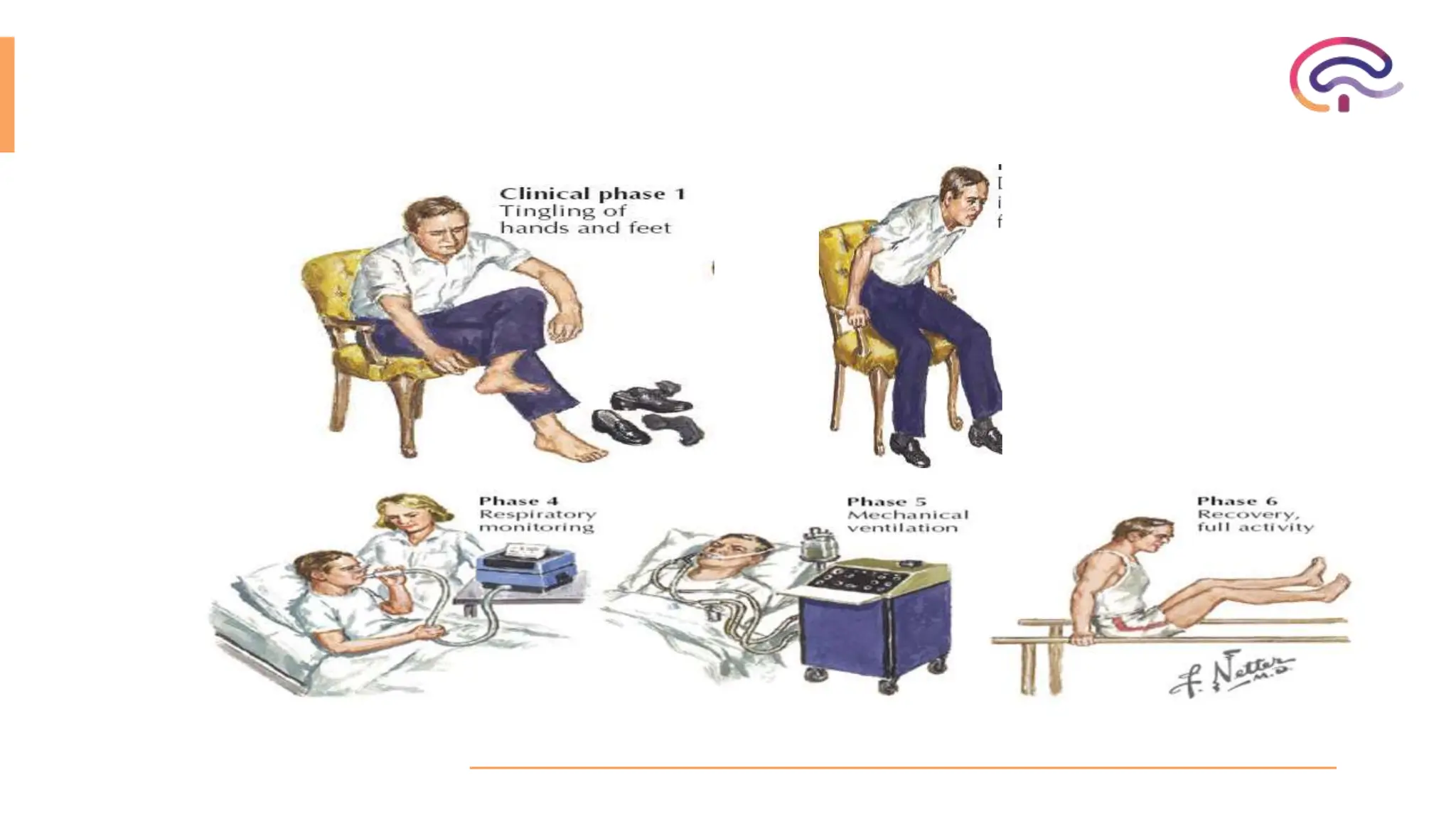 peripheral neuropathy (introduction and Gillian barre syndrome .pptx