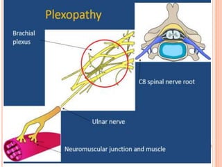Peripheral neuropathy | PPTX