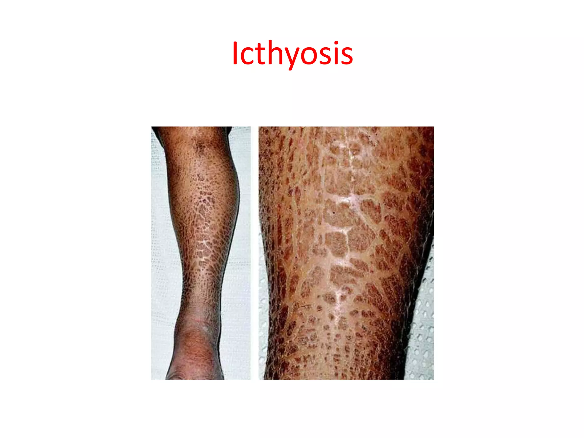 Peripheral neuropathy in systemic disease children | PPTX