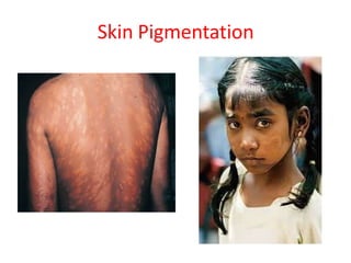 Peripheral neuropathy in systemic disease children | PPTX