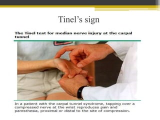 Peripheral neuropathy objective 3 (cts) | PPT