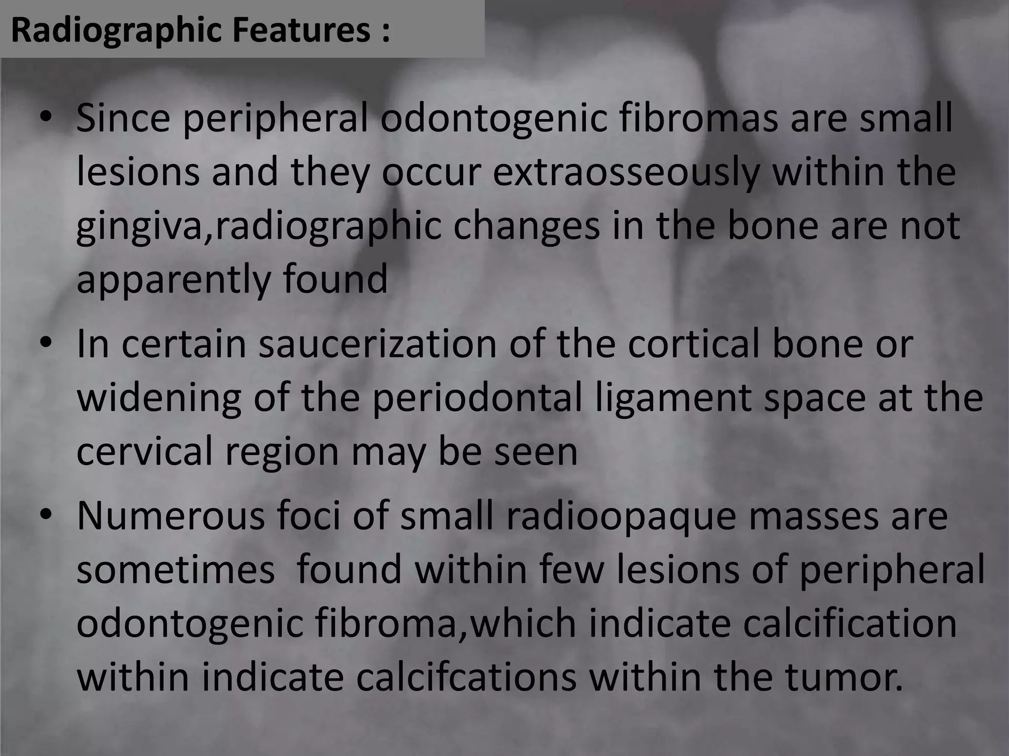 Peripheral odontogenic fibroma | PPTX