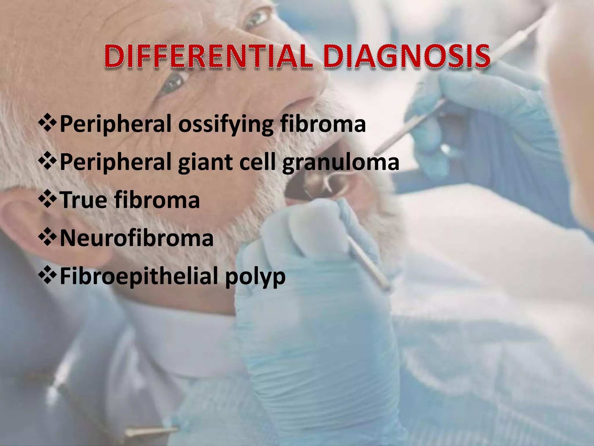 Peripheral odontogenic fibroma | PPTX