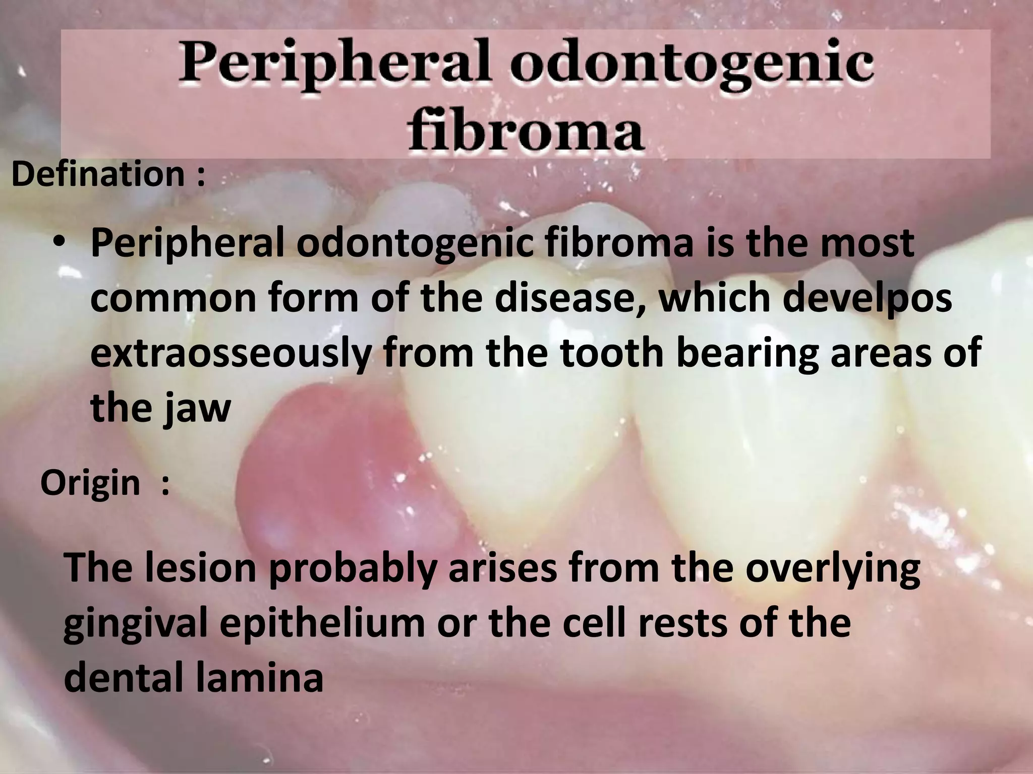 Peripheral odontogenic fibroma | PPTX