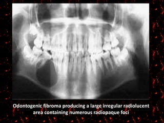 Peripheral Ossifying Fibroma Radiograph
