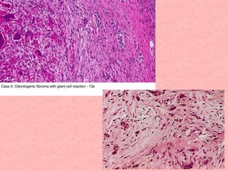 Central Odontogenic Fibroma Histology