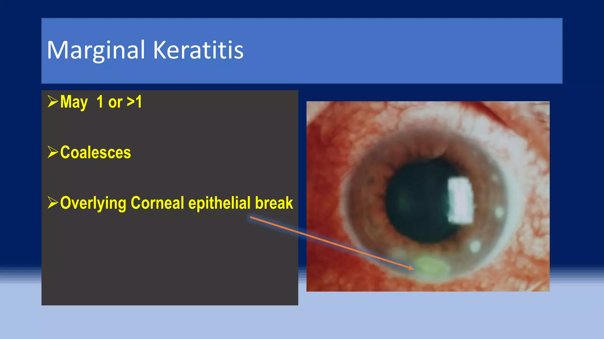 Peripheral or Marginal keratitis_025603.pptx