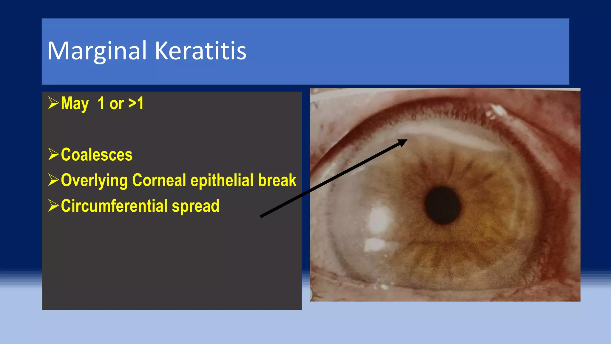 Peripheral or Marginal keratitis_025603.pptx