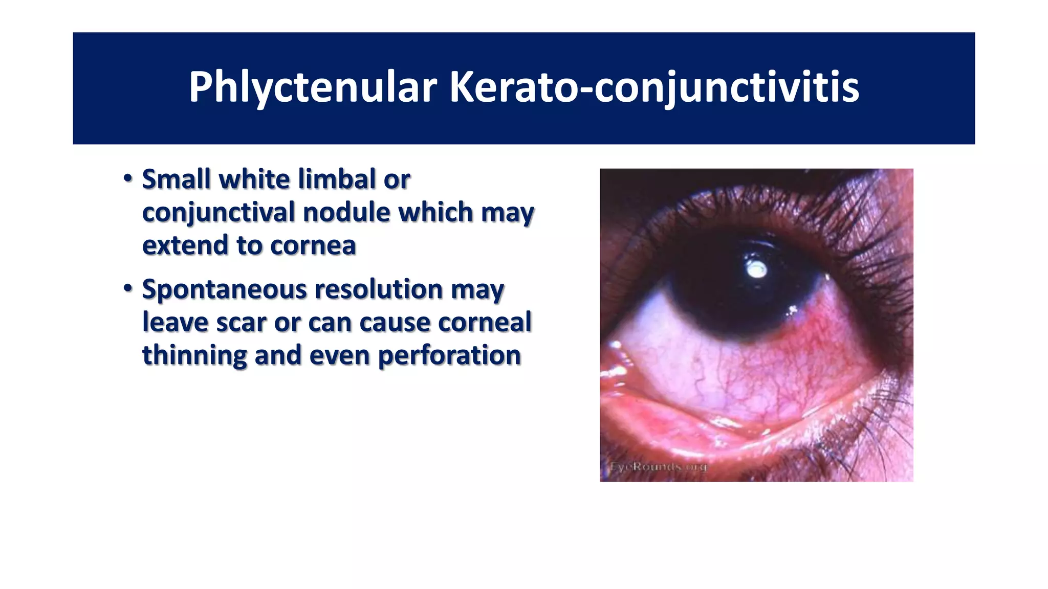 Peripheral or Marginal keratitis_025603.pptx