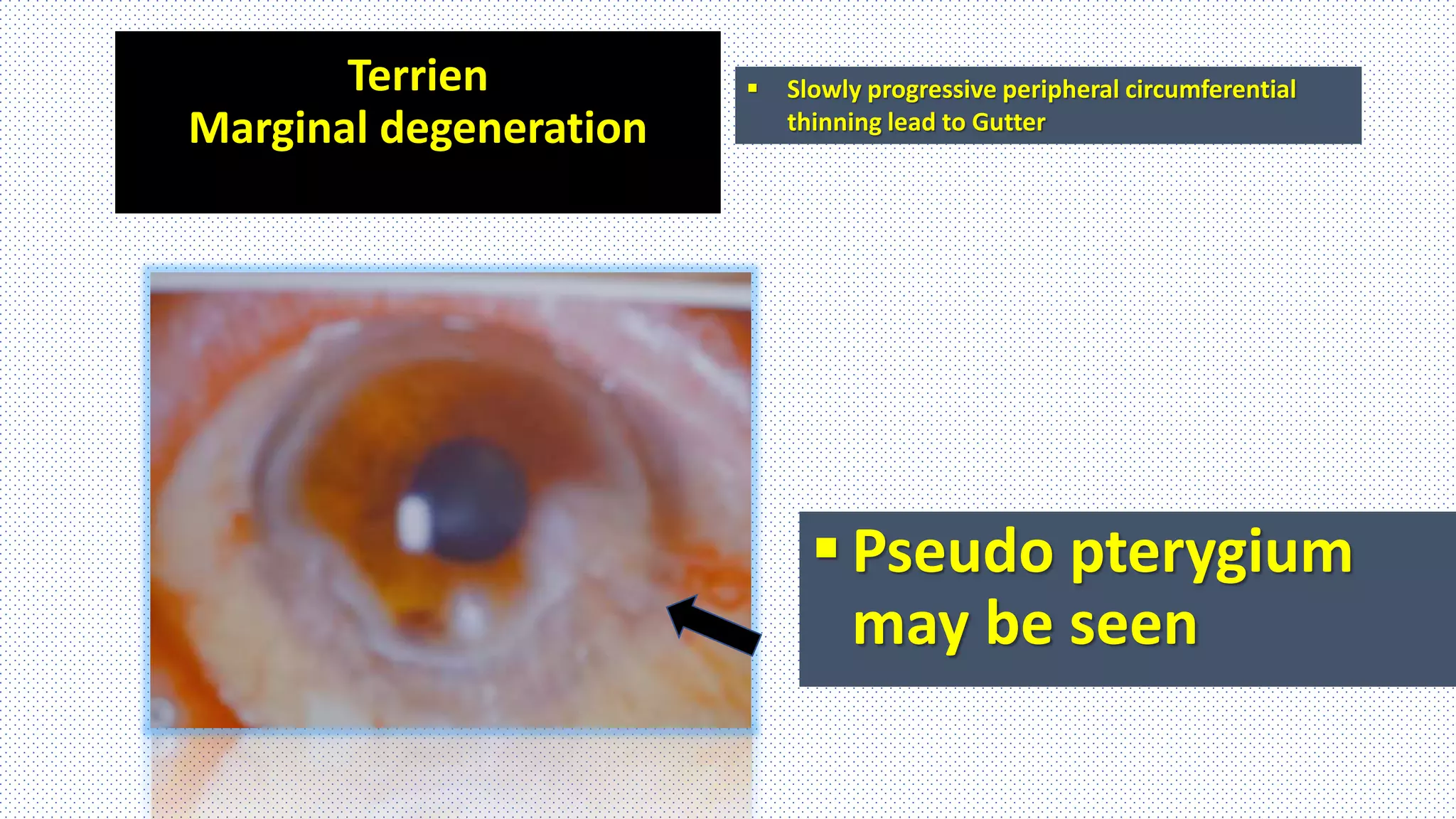 Peripheral or Marginal keratitis_025603.pptx