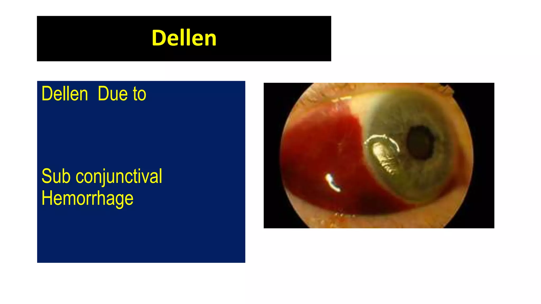 Peripheral or Marginal keratitis_025603.pptx