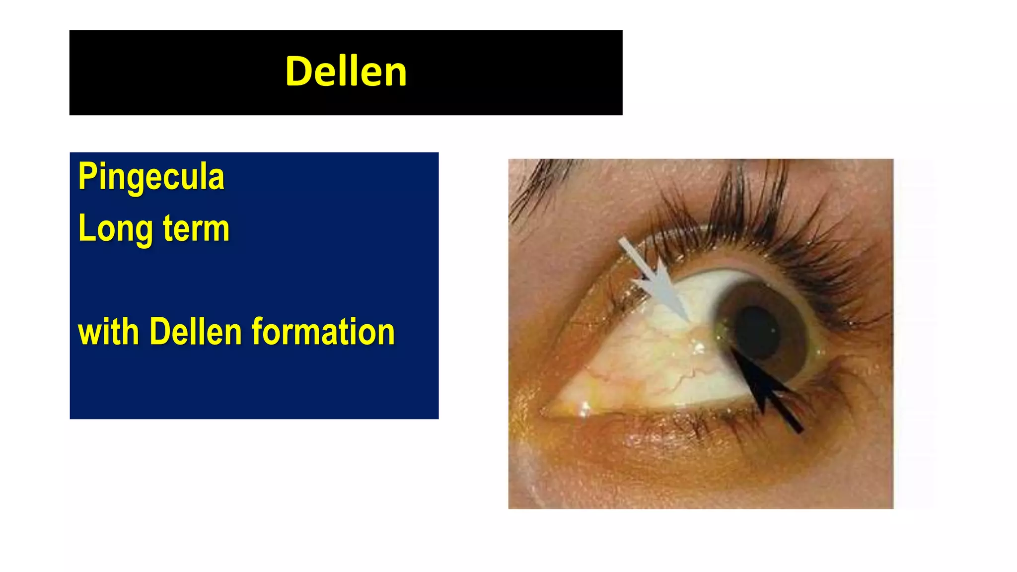 Peripheral or Marginal keratitis_025603.pptx