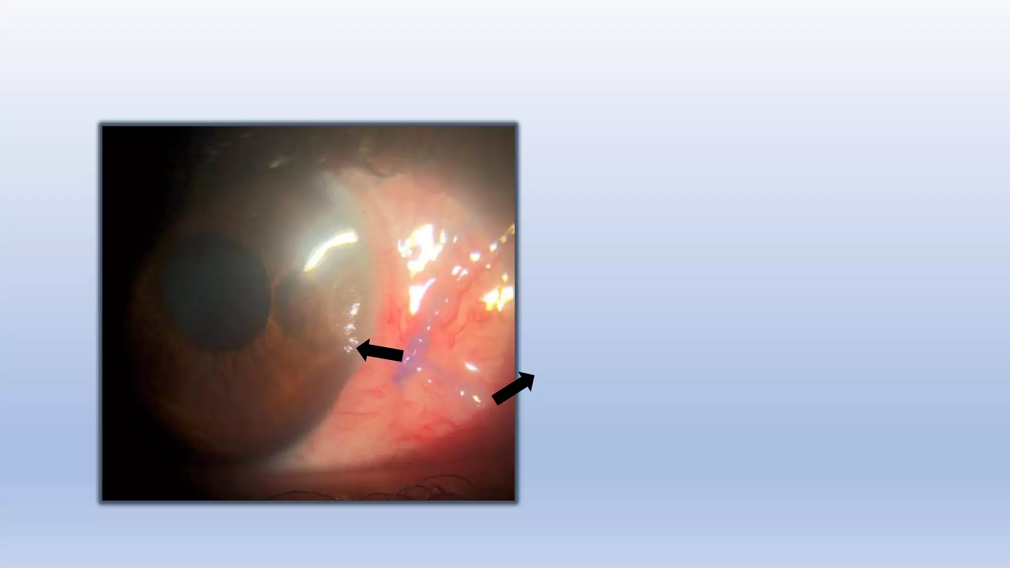 Peripheral or Marginal keratitis_025603.pptx