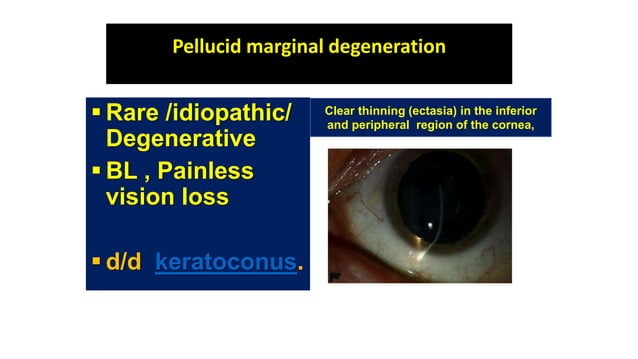 Peripheral or Marginal keratitis_025603.pptx