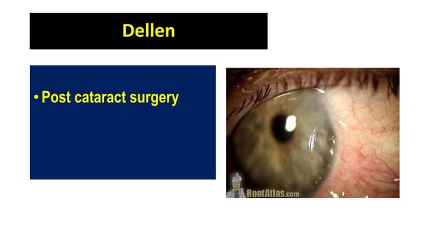 Peripheral or Marginal keratitis_025603.pptx