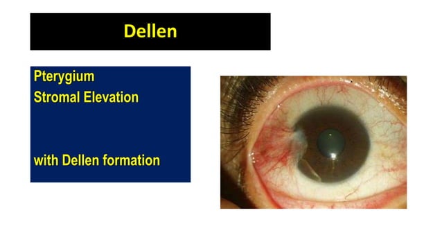 Peripheral or Marginal keratitis_025603.pptx