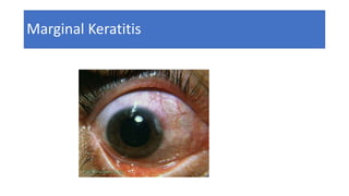 Marginal Keratitis