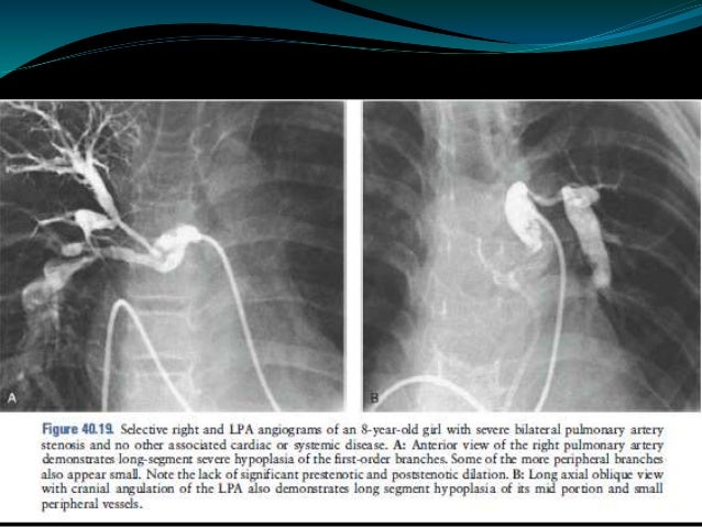 Peripheral Pulmonary Stenosis – Treatment of Peripheral Pulmonary ...